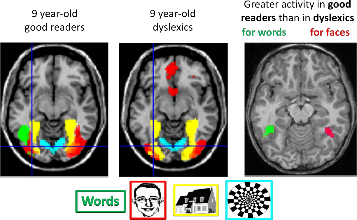 A Parent's Guide to the Neuroscience of Dyslexia
